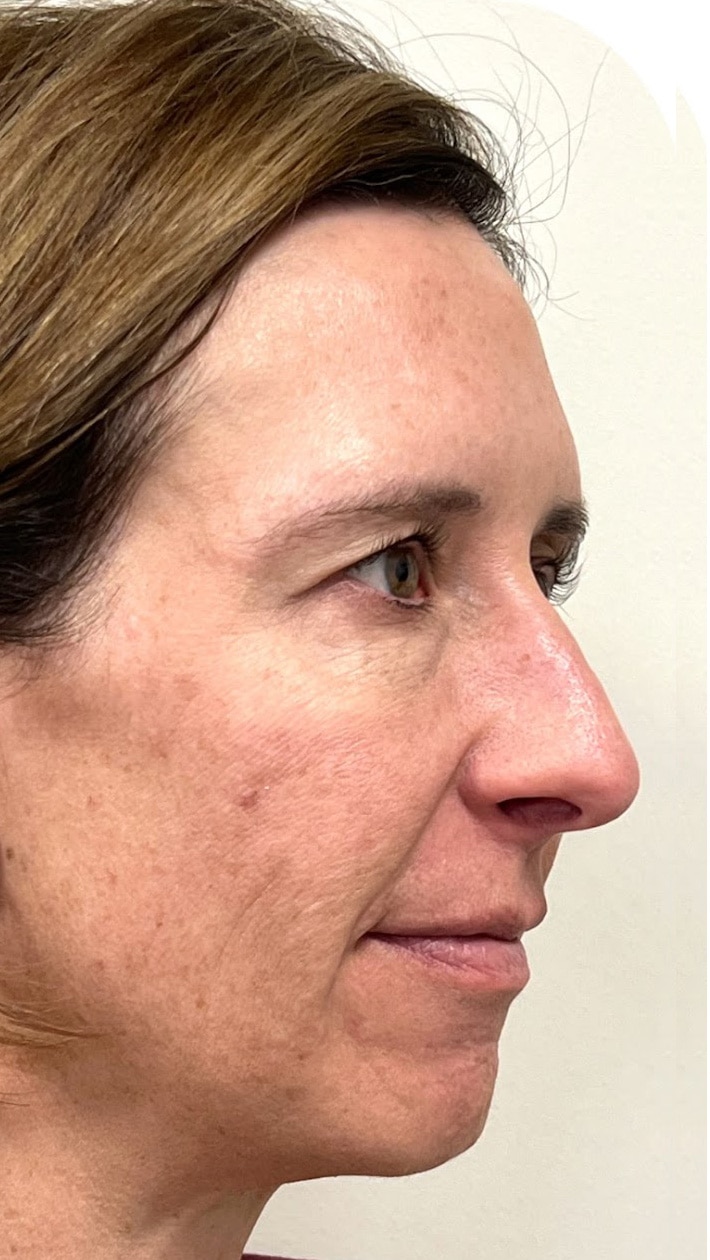 Biostimulator & Filler Archives - FaceIQ MedSpa