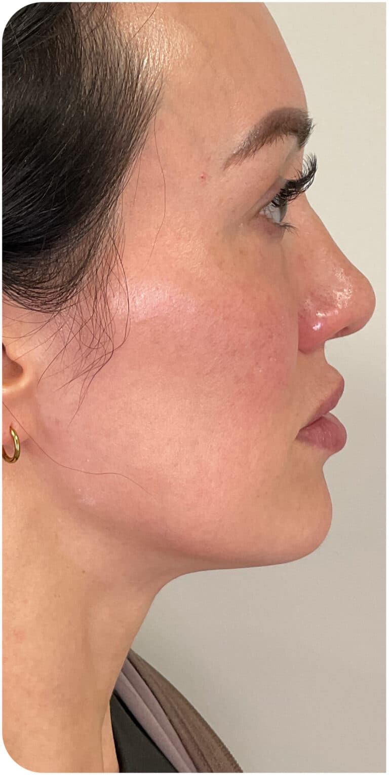 Biostimulator and CO2 Skin Resurfacing - FaceIQ MedSpa