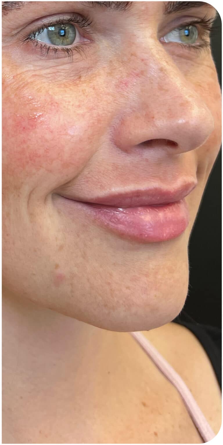 Facial Framing Archives - FaceIQ MedSpa