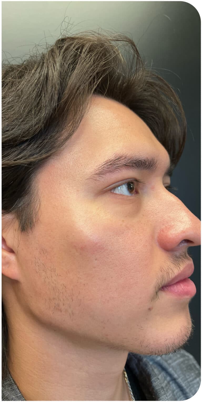 Jawline - FaceIQ MedSpa