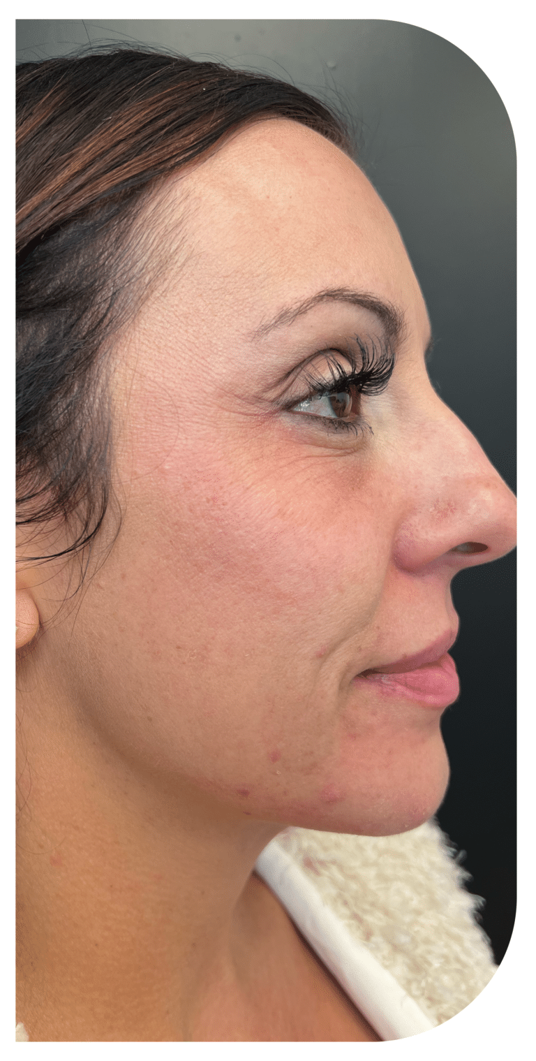 CO2 Skin Resurfacing - FaceIQ MedSpa