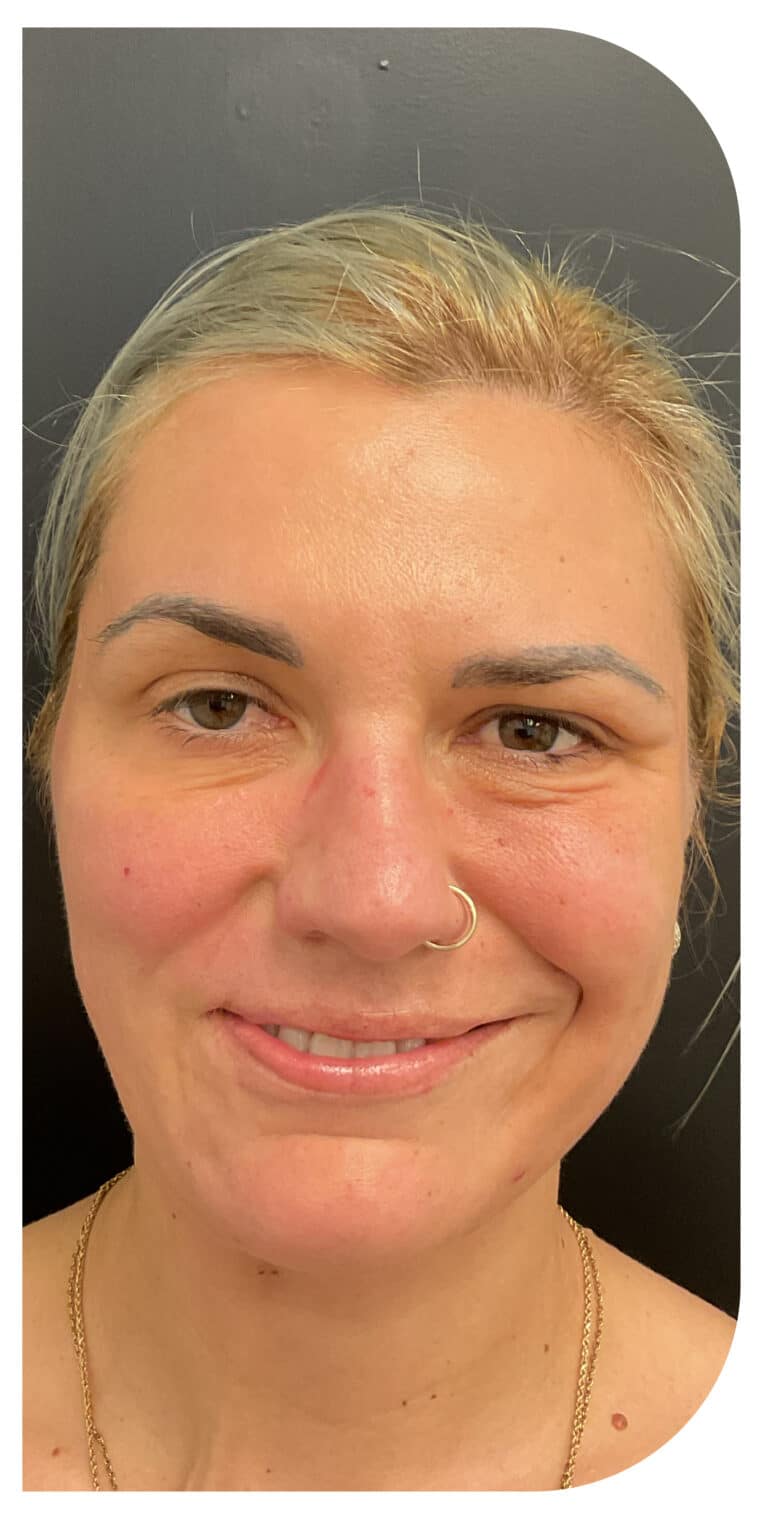 Botox on facial paralysis - FaceIQ MedSpa