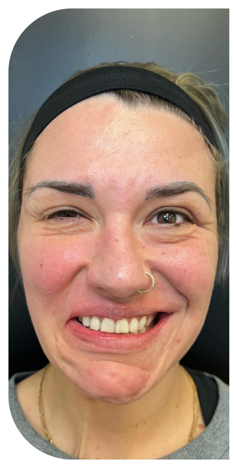 Botox on facial paralysis - FaceIQ MedSpa