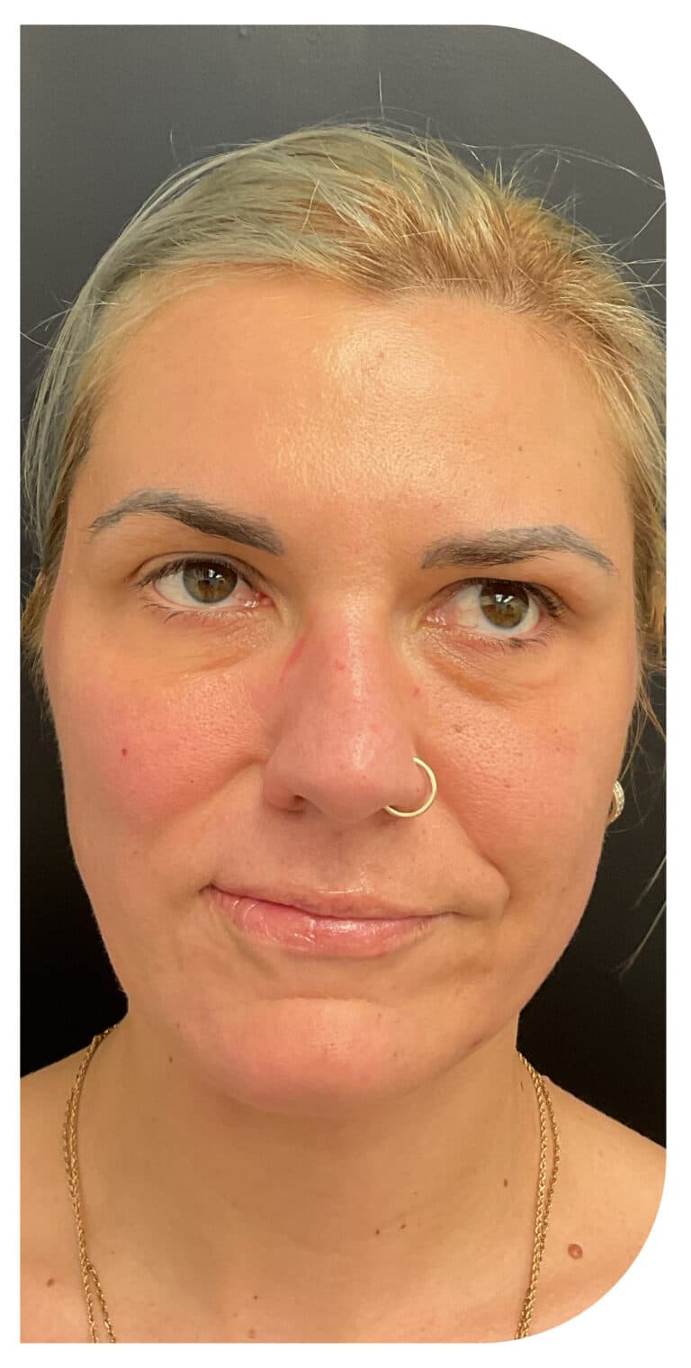 Botox on facial paralysis - FaceIQ MedSpa