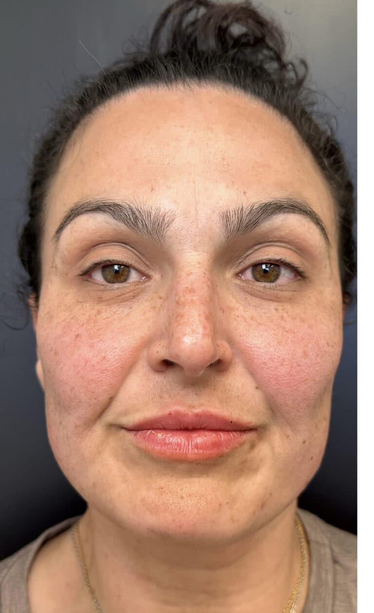 Facial Framing Archives - FaceIQ MedSpa